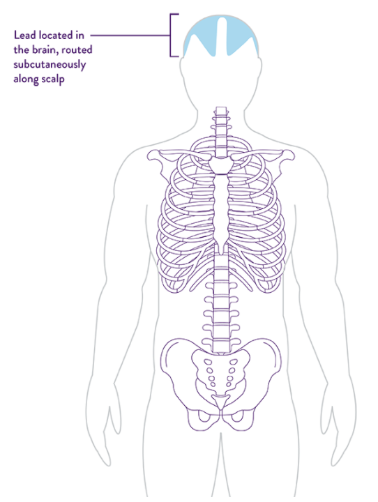 MRI Support—DBS Lead-Only | Abbott