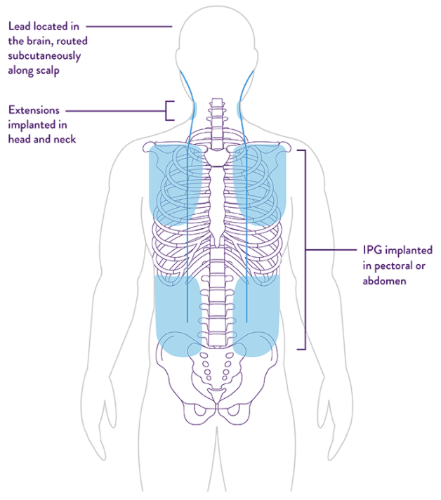 MRI Support—DBS Full Systems | Abbott