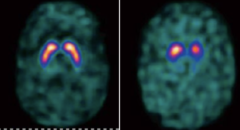 Hear What People Say About Deep Brain Stimulation | Abbott