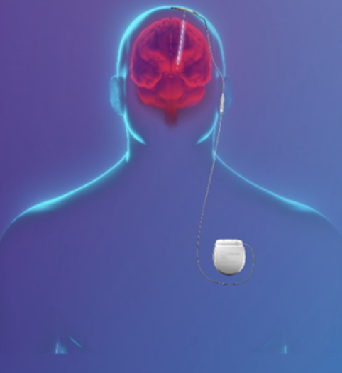How DBS Therapy Helps Treat Parkinson's | Abbott